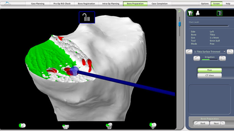 Le robot Mako leader de la chirurgie robotique en orthopédie - CHROMA ...